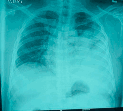Hemothorax X Ray